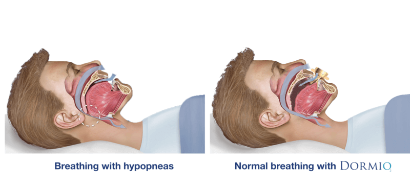Sleep Apnea Solution – DORMIO – On Acupuncture and Otolaryngology